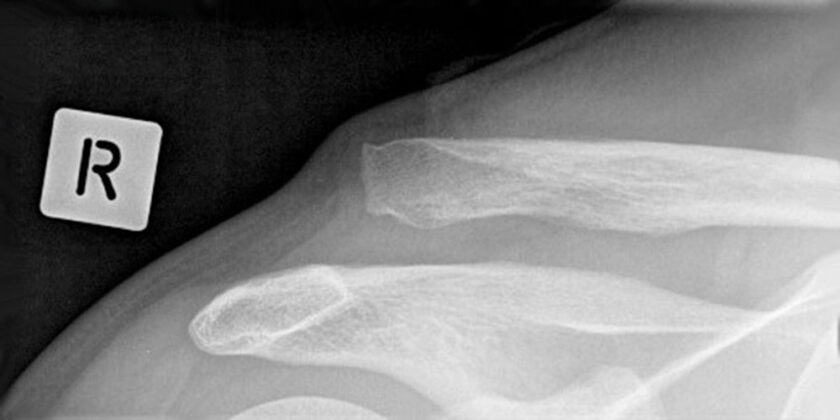 Acromio-clavicular Joint Reconstruction - Dr Sunil Reddy - Orthopaedics ...
