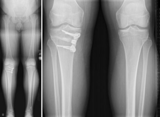 High Tibial Osteotomy - Dr Sunil Reddy - Orthopaedics Adelaide