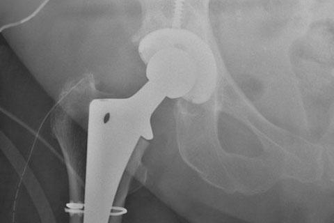 Prosthetic Joint Infection - two recent studies shed some light on risk ...