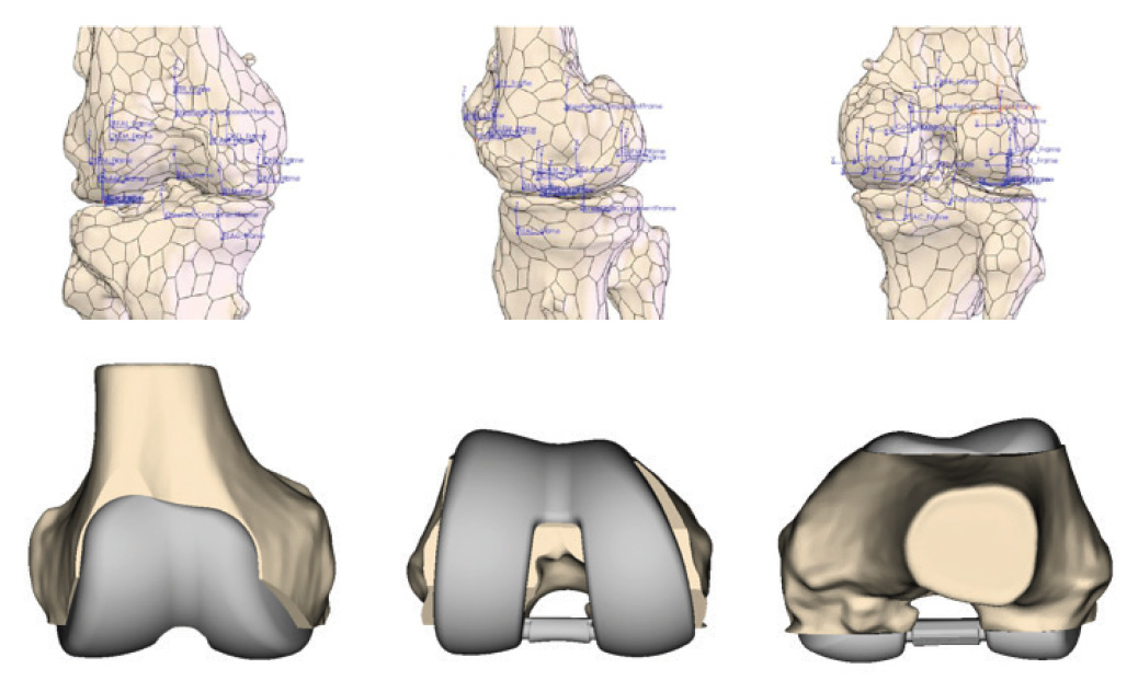 Custom Total Knee Replacement - Dr Sunil Reddy - Orthopaedics Adelaide