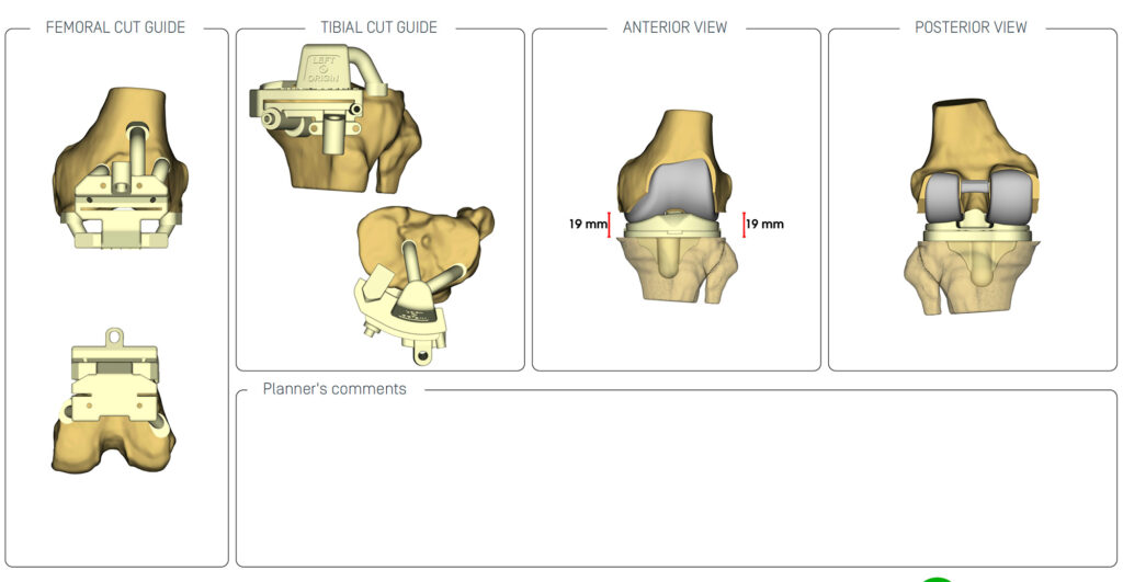 Custom Total Knee Replacement - Dr Sunil Reddy - Orthopaedics Adelaide